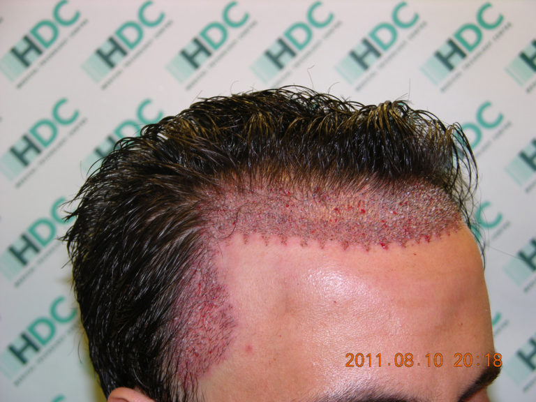 Hair Transplant In Delhi Before And After Bolg